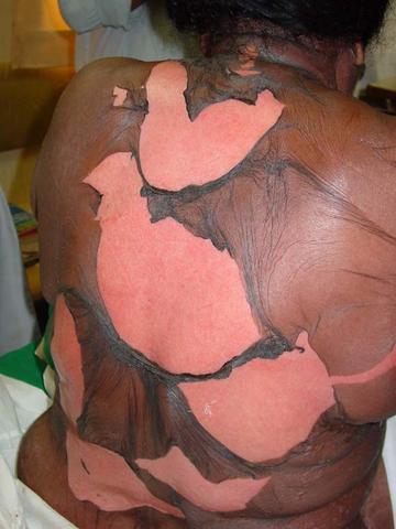 Injection de glutathion : Une nouvelle forme de dépigmentation qui tue ...